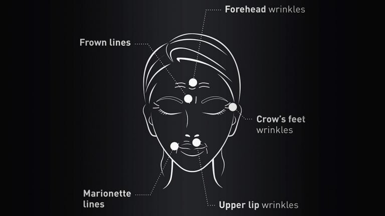 What Are Expression Lines And How Can They Be Reduced? | Filorga UK